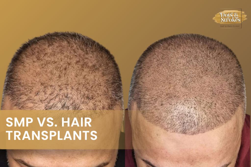 Scalp Micropigmentation vs. Hair Transplants: Which Is Better for You ...